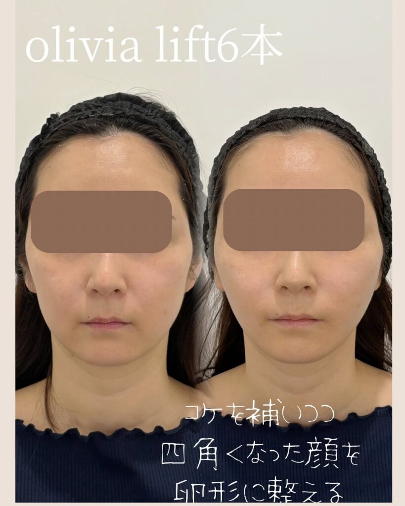 49 Olivia lift – Olivia clinic 症例写真