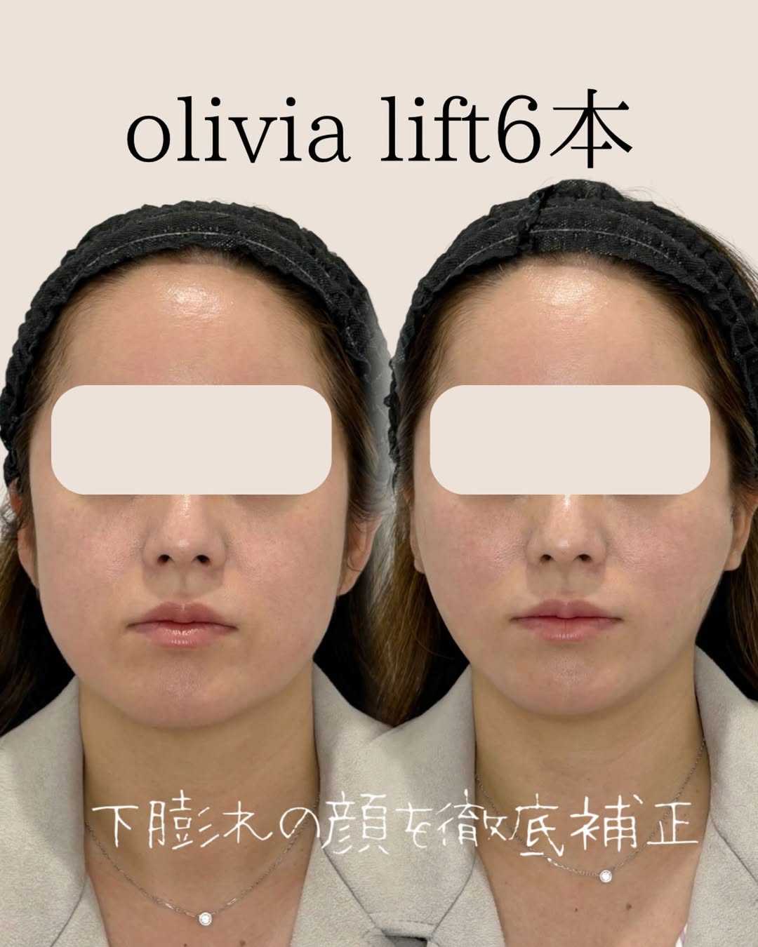52 Olivia lift – Olivia clinic 症例写真