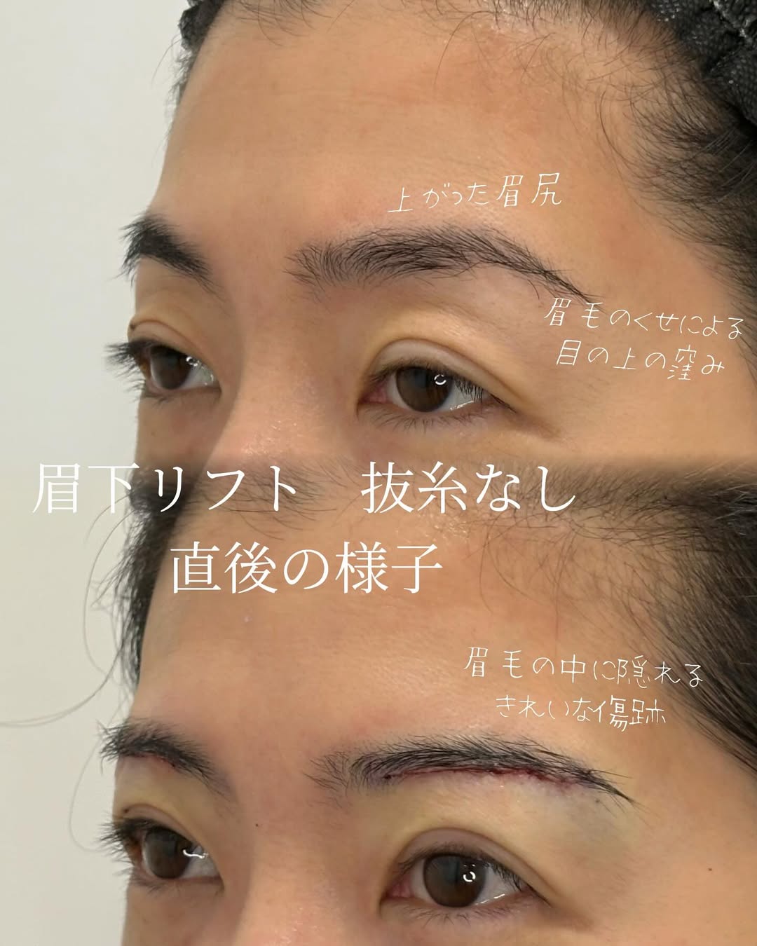 66 眉下リフト – Olivia clinic 症例写真