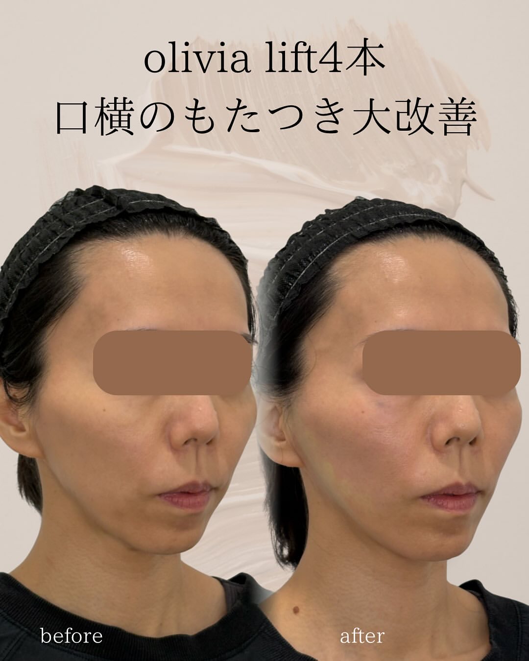 91 Olivia lift – Olivia clinic 症例写真