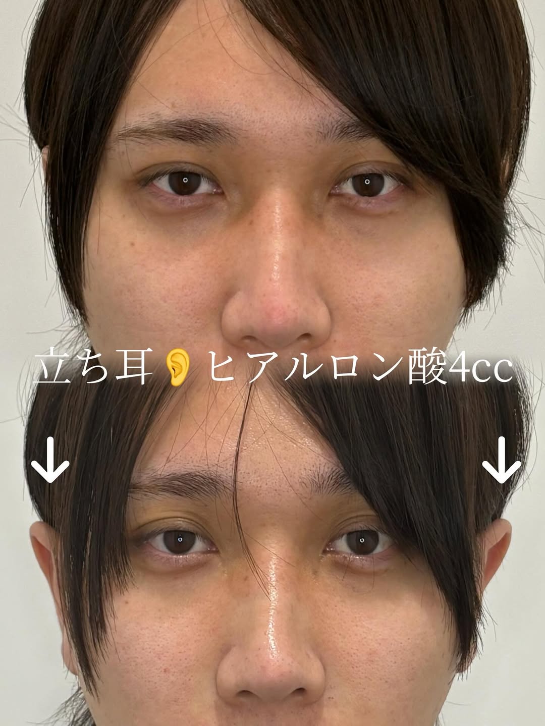110 立ち耳ヒアルロン酸 – Olivia clinic 症例写真