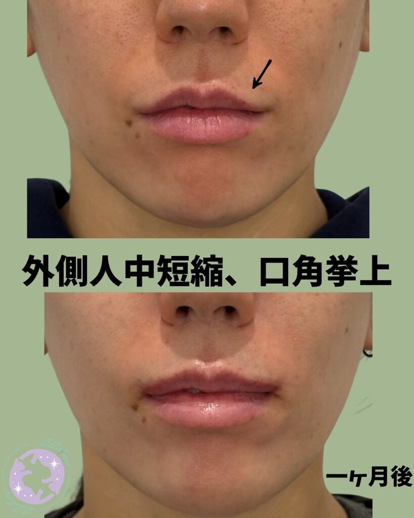 141 外側人中短縮 × 口角拳上 × ボトックス注射 – Olivia clinic 症例写真